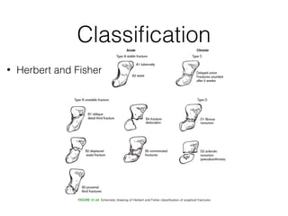 Orthokorat scaphoid fx c perilunate dislocation | PPT