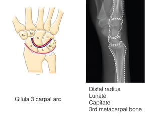Orthokorat scaphoid fx c perilunate dislocation | PPT
