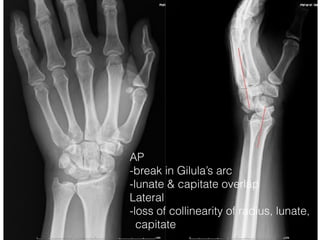 Orthokorat scaphoid fx c perilunate dislocation | PPT