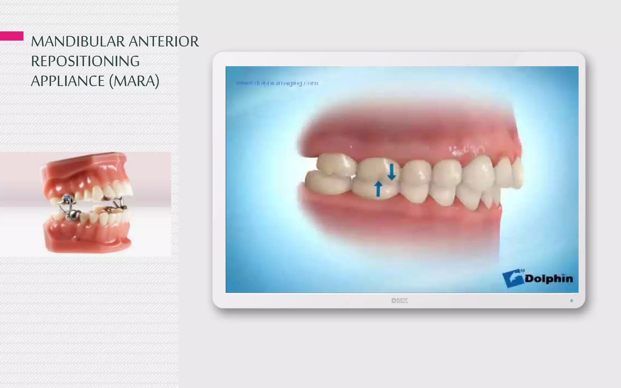 Definition, etiology and treatment of class II malocclusion | PPTX