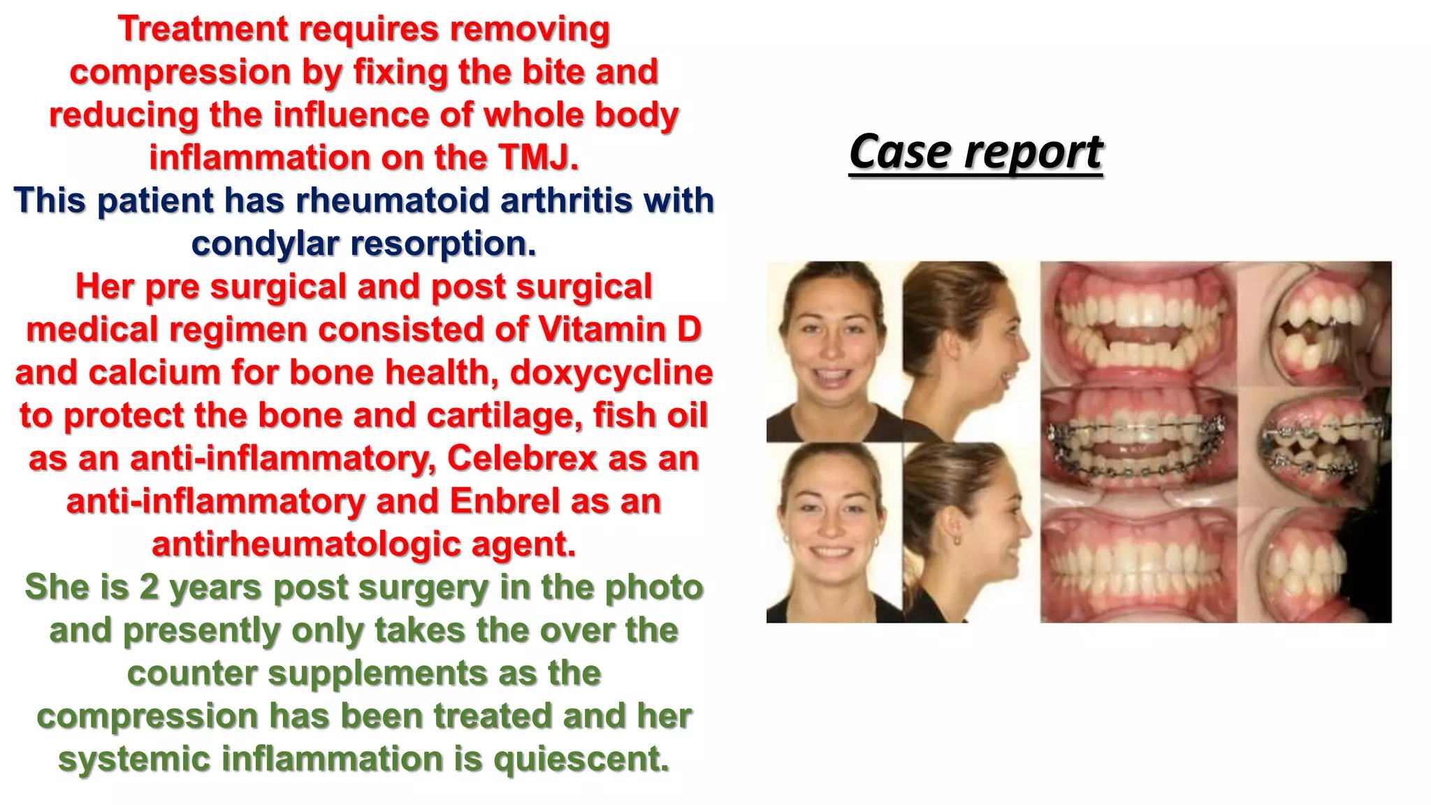 Ortho manage of idiopathic condylar resorption part 1 | PPTX