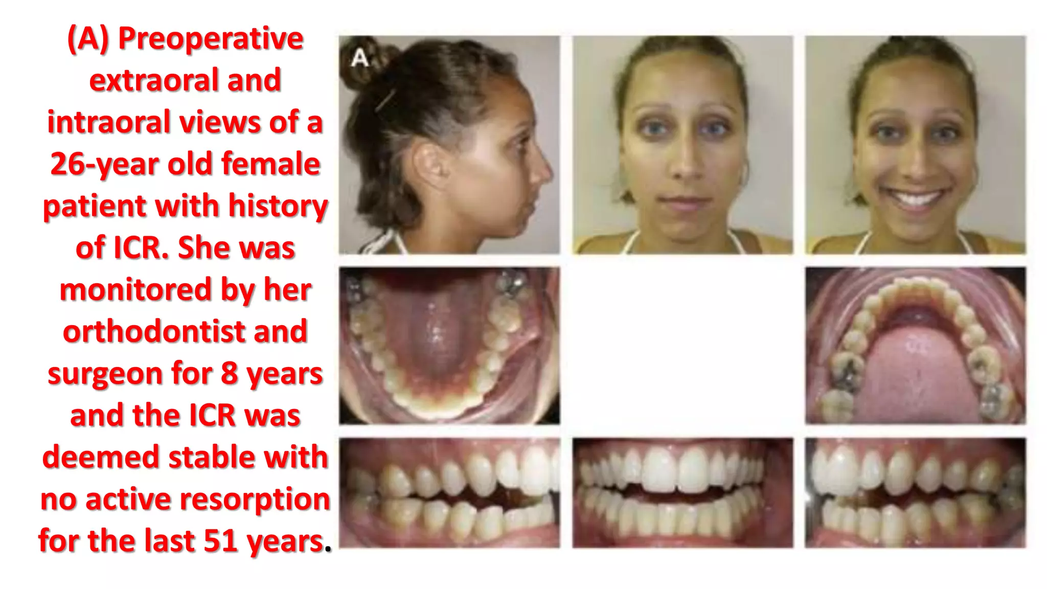 Ortho manage of idiopathic condylar resorption part 1 | PPTX