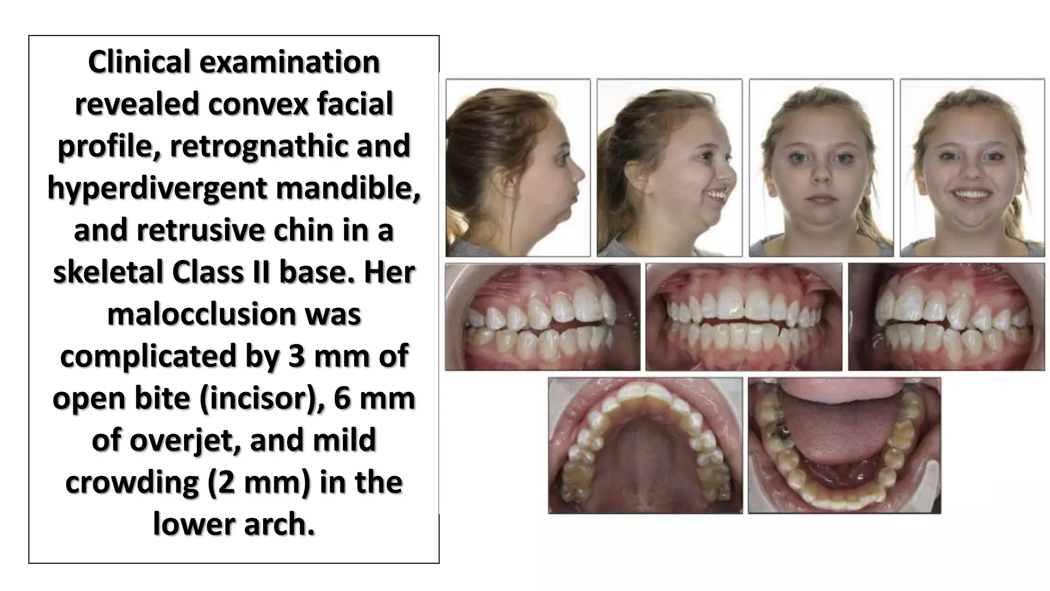 Ortho manage of idiopathic condylar resorption part 1 | PPTX
