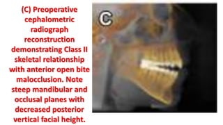 Ortho manage of idiopathic condylar resorption part 1 | PPTX