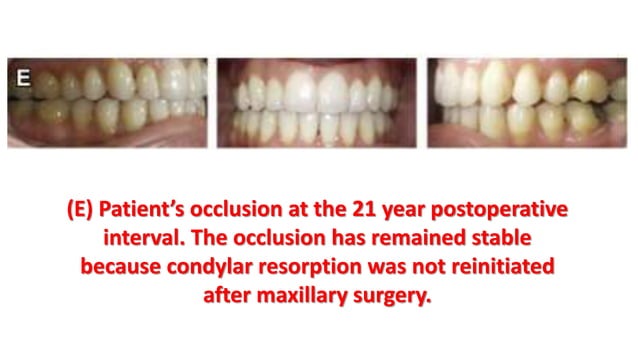 Ortho manage of idiopathic condylar resorption part 1 | PPTX | Bone and ...