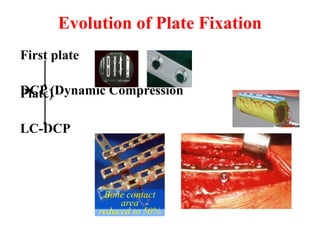 orthopaedic implant.pptx orthopaedic implant.pptx
