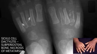 Orthopaedic overview of sickle cell anemia | PPTX