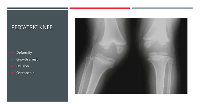 Orthopaedic overview of sickle cell anemia | PPTX