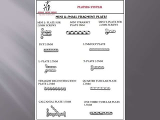 Orthopaedic Plating Implants | PPT