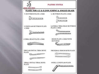 Orthopaedic Plating Implants | PPSX