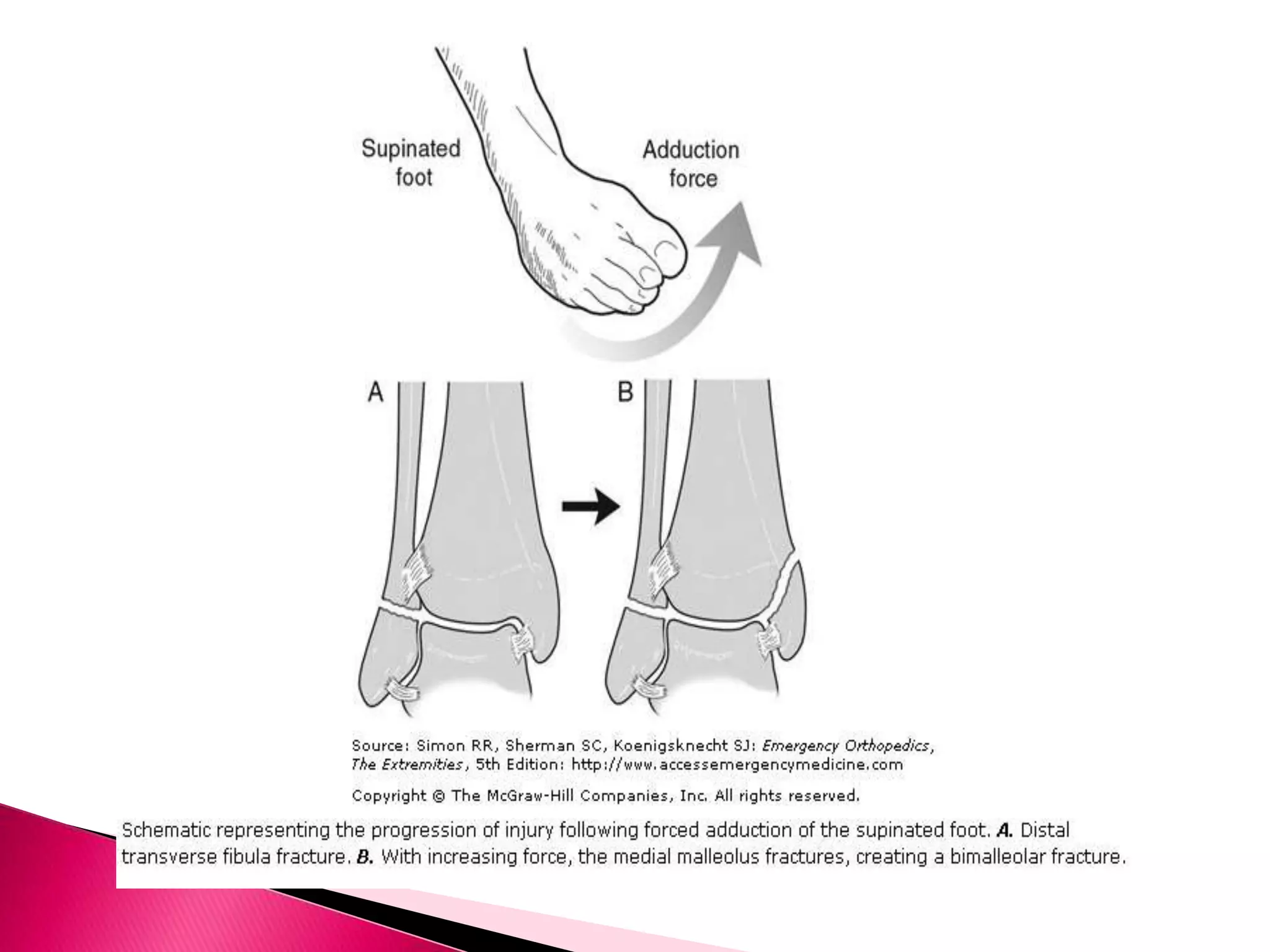 Tibia and fibula diaphysis, ankle and foot injuries | PPTX