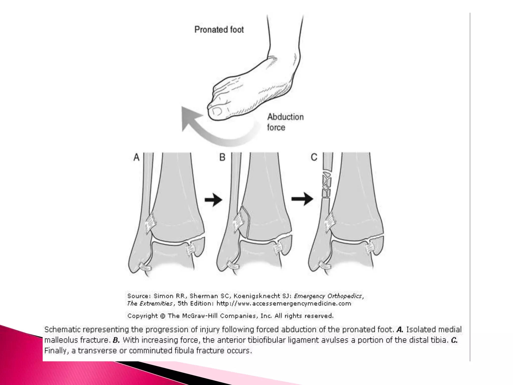 Tibia and fibula diaphysis, ankle and foot injuries | PPTX