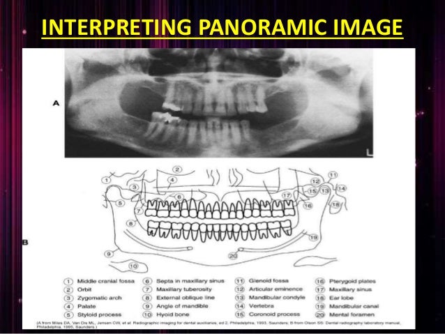 Orthopantomogram.ppt