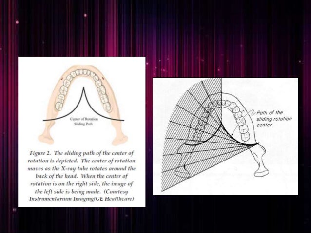 Orthopantomogram Meaning