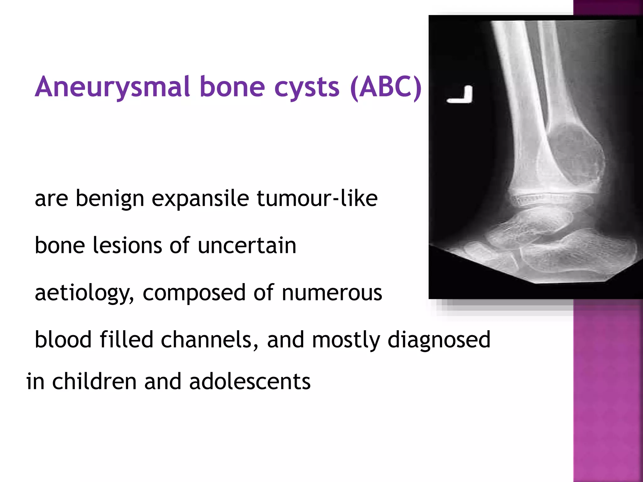 Ortho Patho Meet on Aneurysmal Bone Cyst by Dr. Saumya Agarwal | PPTX