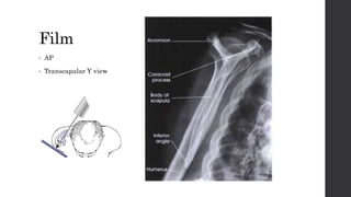 Ant.shoulder dislocation | PPTX