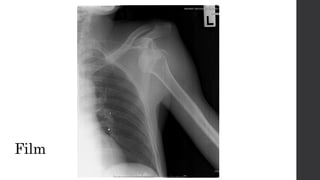 Ant.shoulder dislocation | PPTX