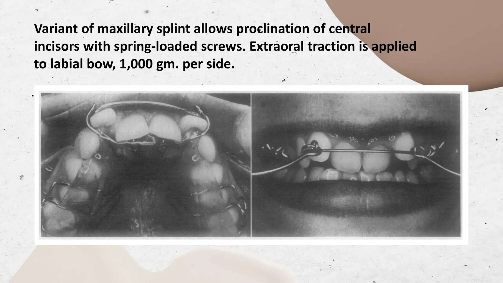 Orthopedic coordination of dentofacial development in skeletal Class II ...
