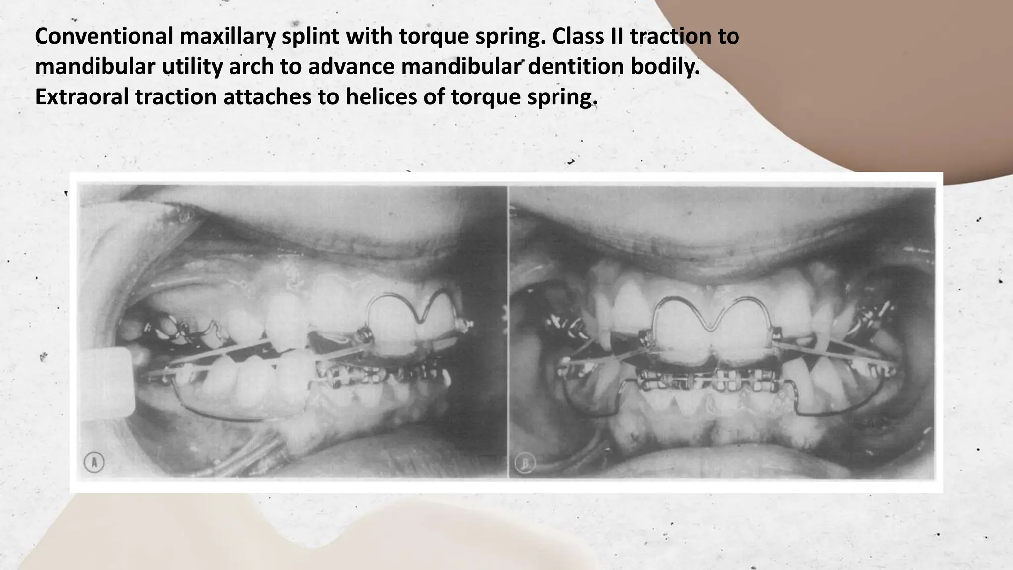 Orthopedic coordination of dentofacial development in skeletal Class II ...