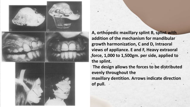 Orthopedic coordination of dentofacial development in skeletal Class II ...