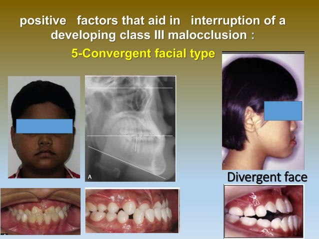 Orthopedic correction of class III | PPT