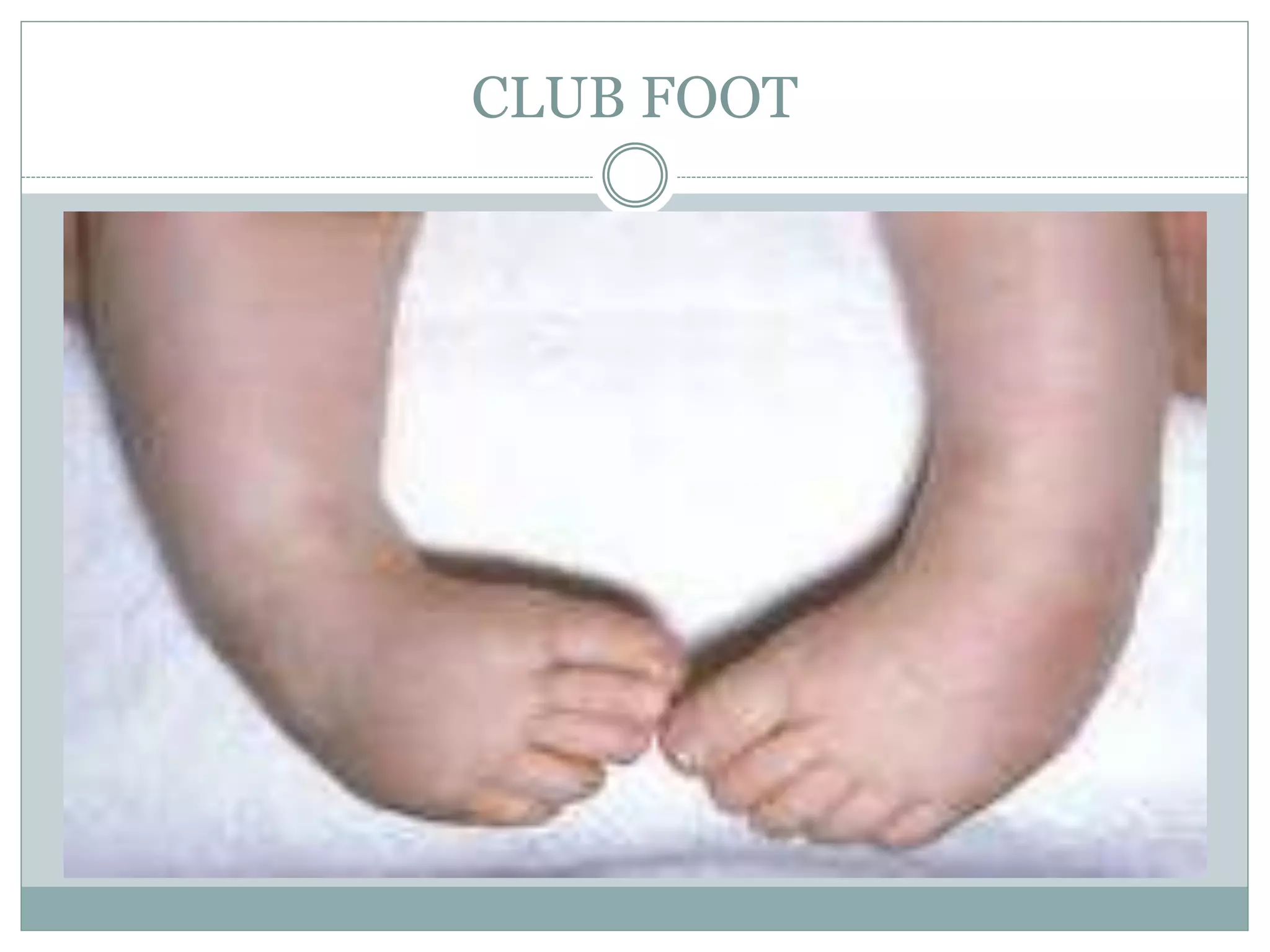 Orthopedic disorders in children | PPTX