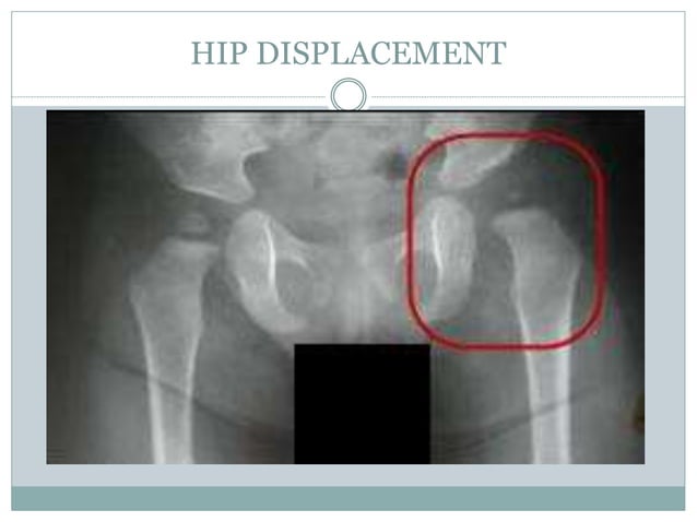 Orthopedic disorders in children | PPTX