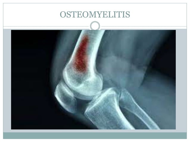 Orthopedic disorders in children | PPTX