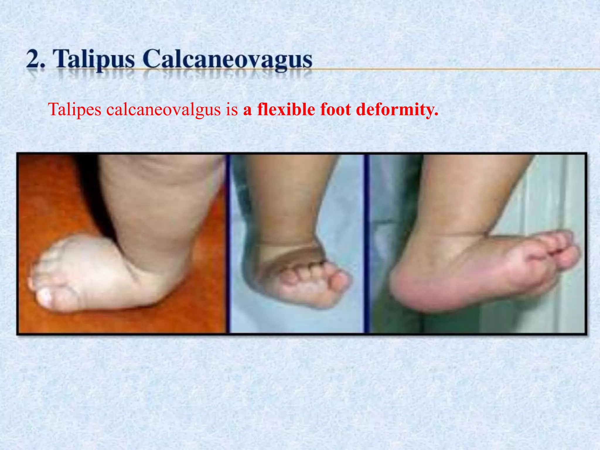 Orthopedic Disorders In Children.pptx