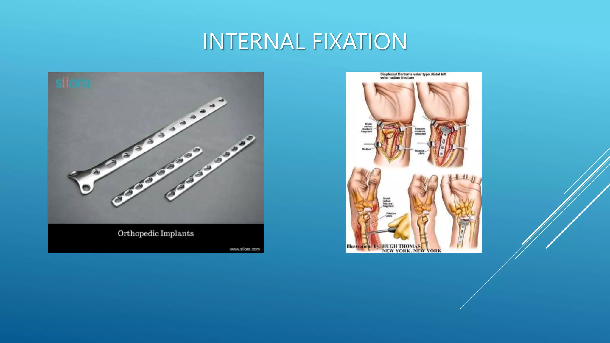 Orthopedic implants.pptx