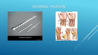 Orthopedic implants.pptx