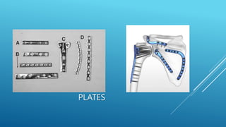 Orthopedic implants.pptx