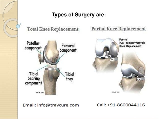Orthopedic surgery for knee replacement
