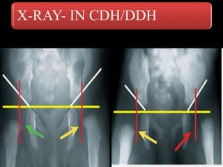 Orthopedic problems in newborn | PPT