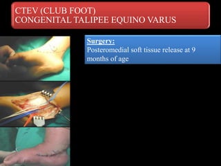 Orthopedic problems in newborn | PPT