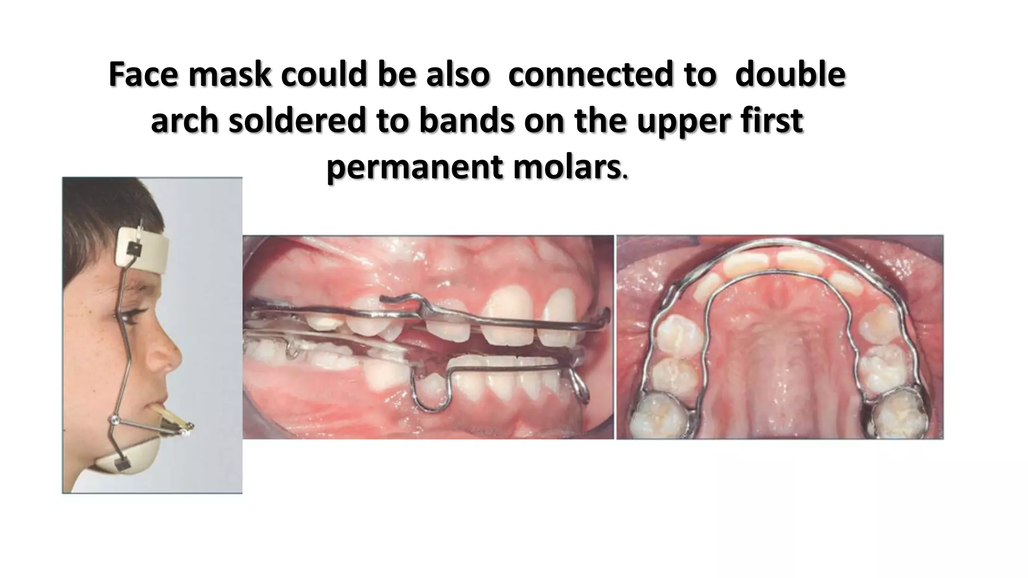 Orthopedic protraction of the maxilla part 1 | PPTX
