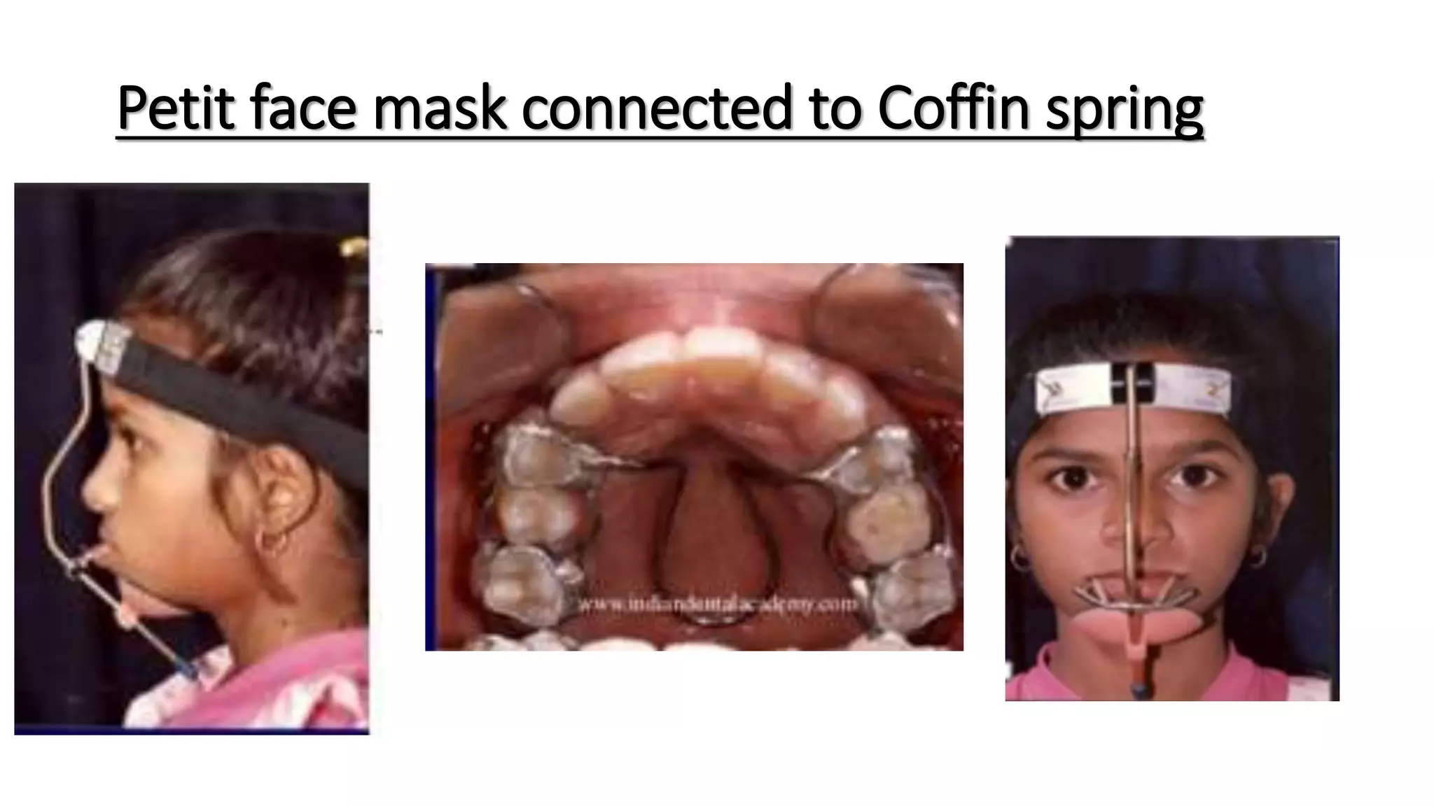 Orthopedic protraction of the maxilla part 1 | PPTX