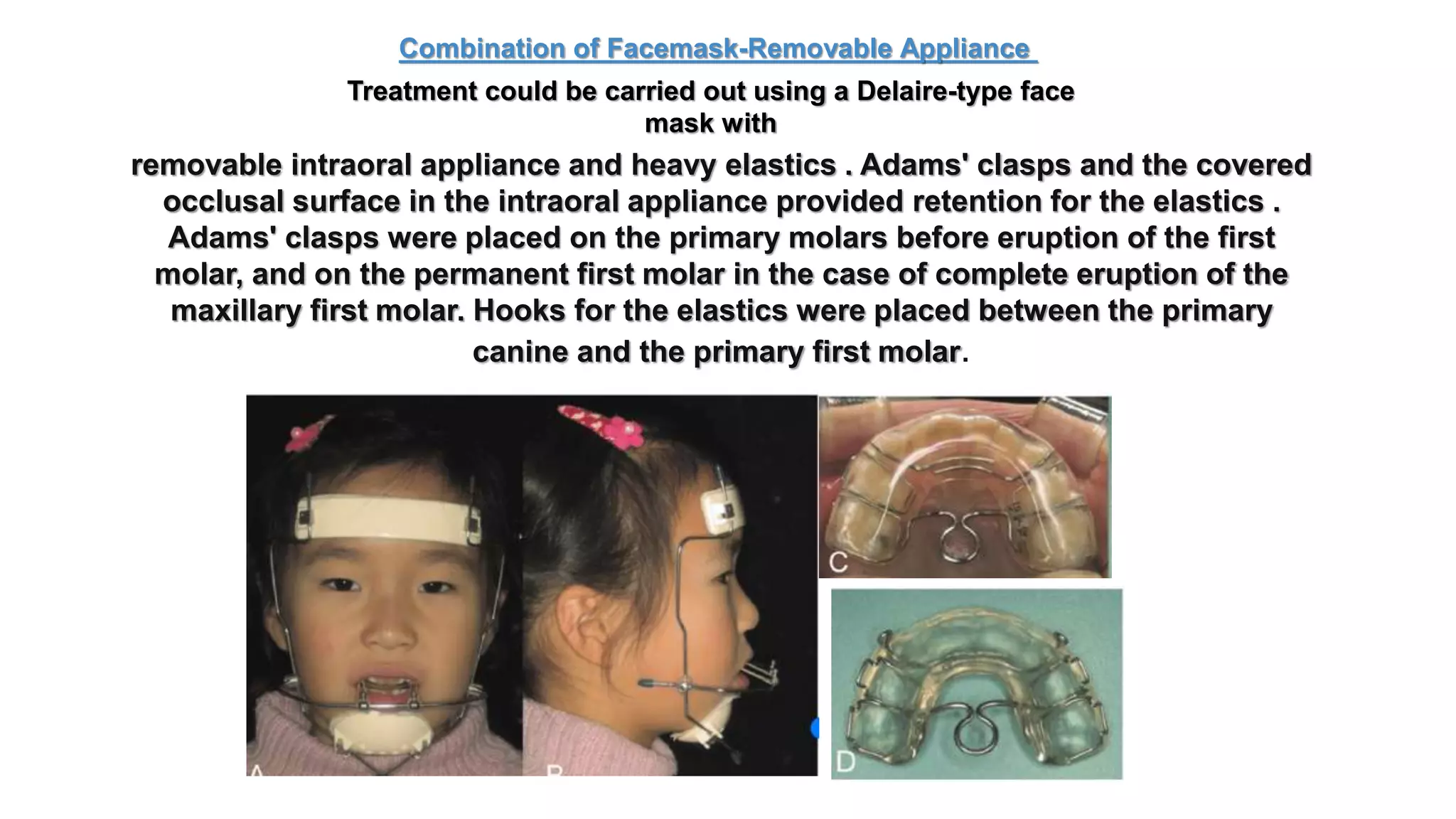 Orthopedic protraction of the maxilla part 1 | PPTX