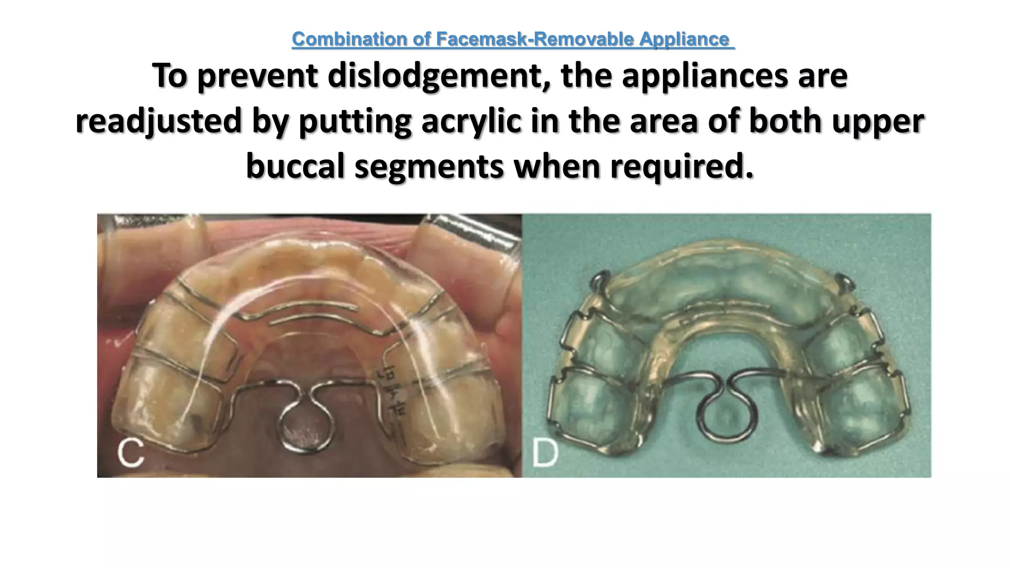 Orthopedic protraction of the maxilla part 1 | PPTX