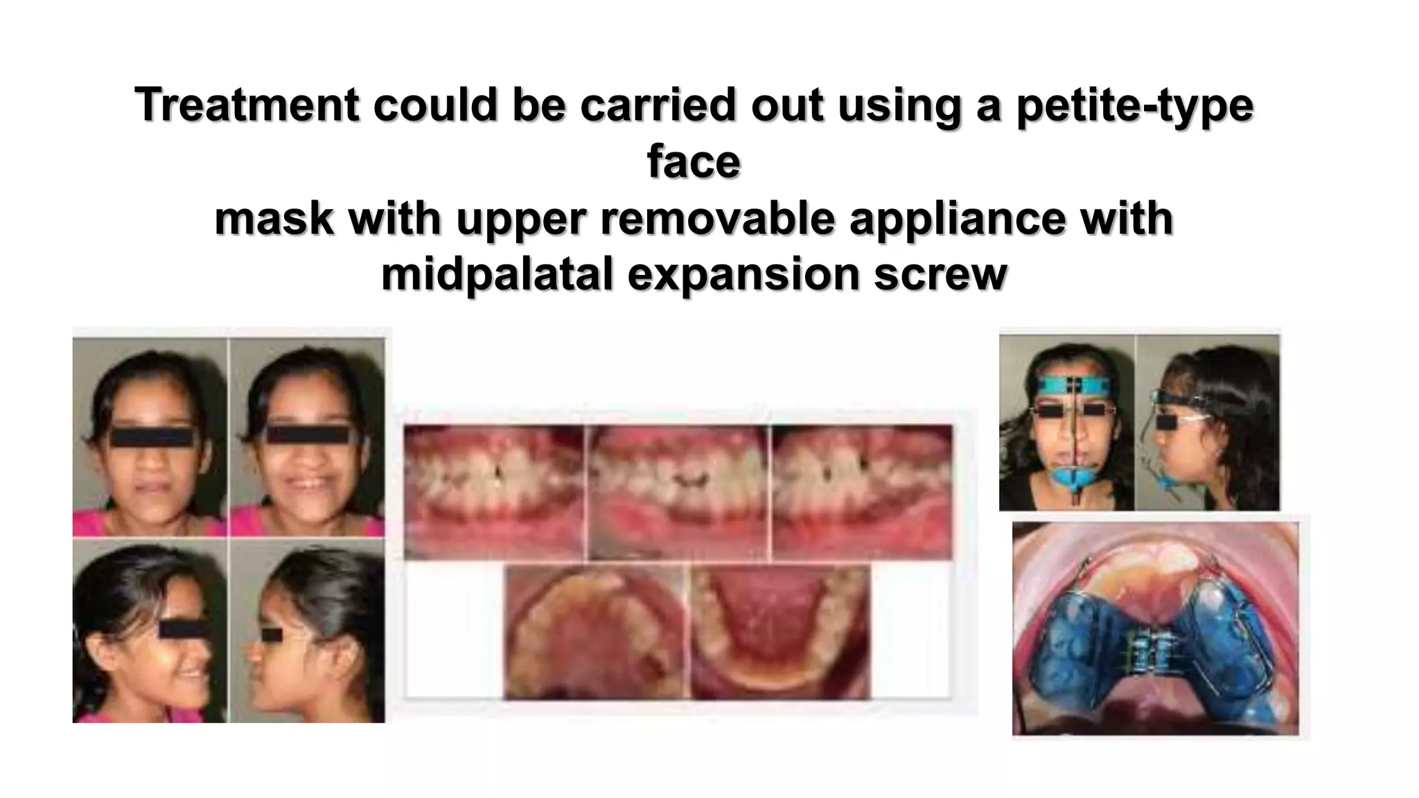 Orthopedic protraction of the maxilla part 1 | PPTX