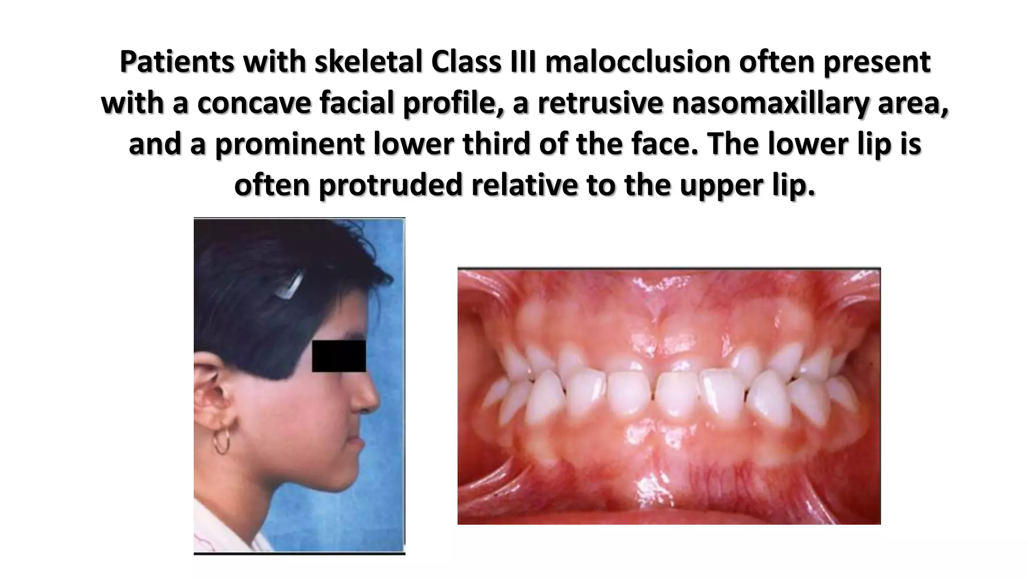 Orthopedic protraction of the maxilla part 1 | PPTX