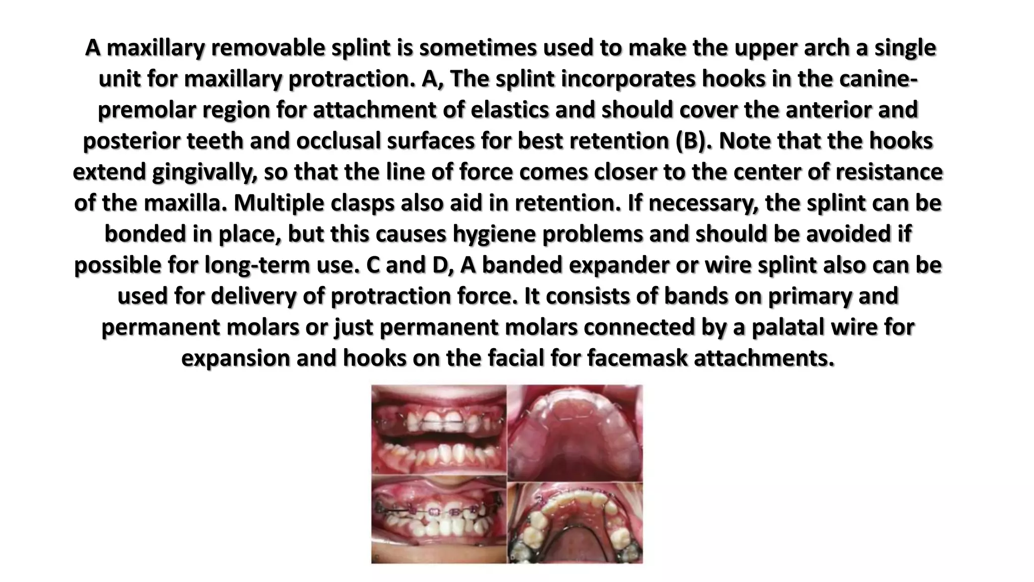Orthopedic protraction of the maxilla part 1 | PPTX | Oral care | Personal Care
