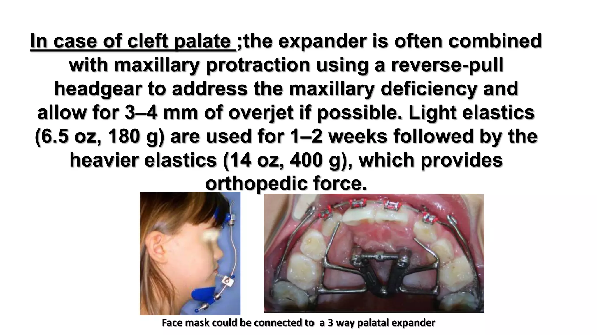 Orthopedic protraction of the maxilla part 1 | PPTX