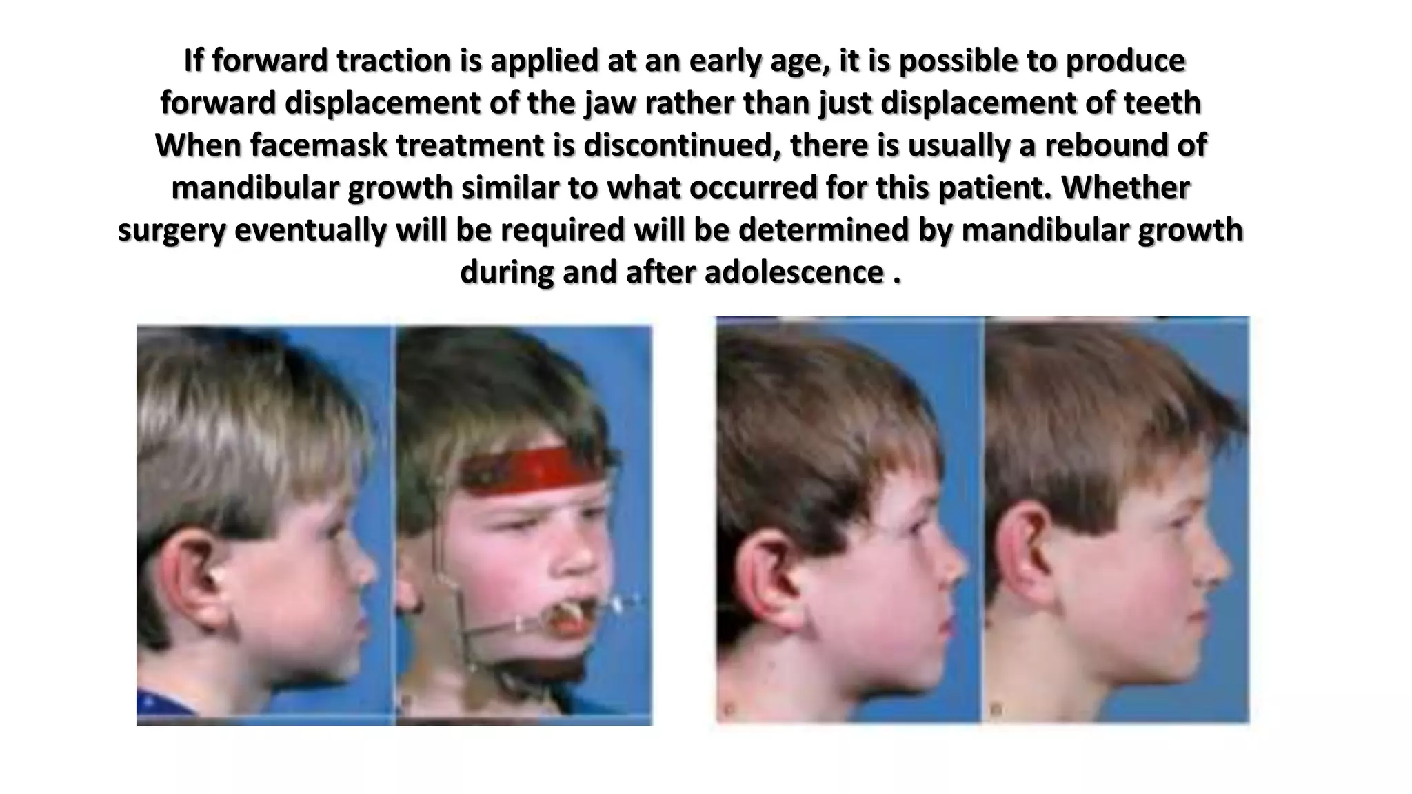 Orthopedic protraction of the maxilla part 1 | PPTX | Oral care | Personal Care