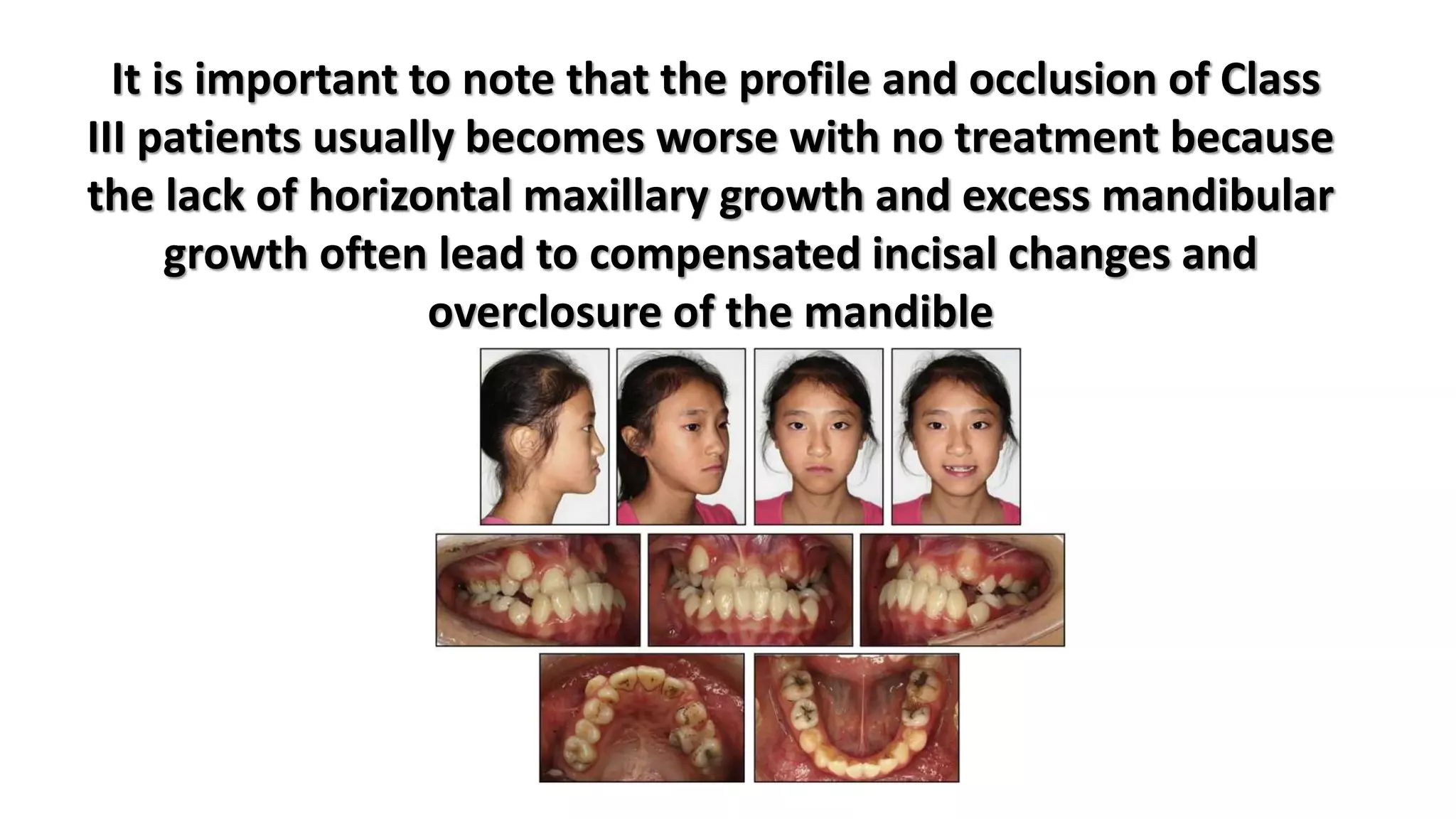 Orthopedic protraction of the maxilla part 1 | PPTX