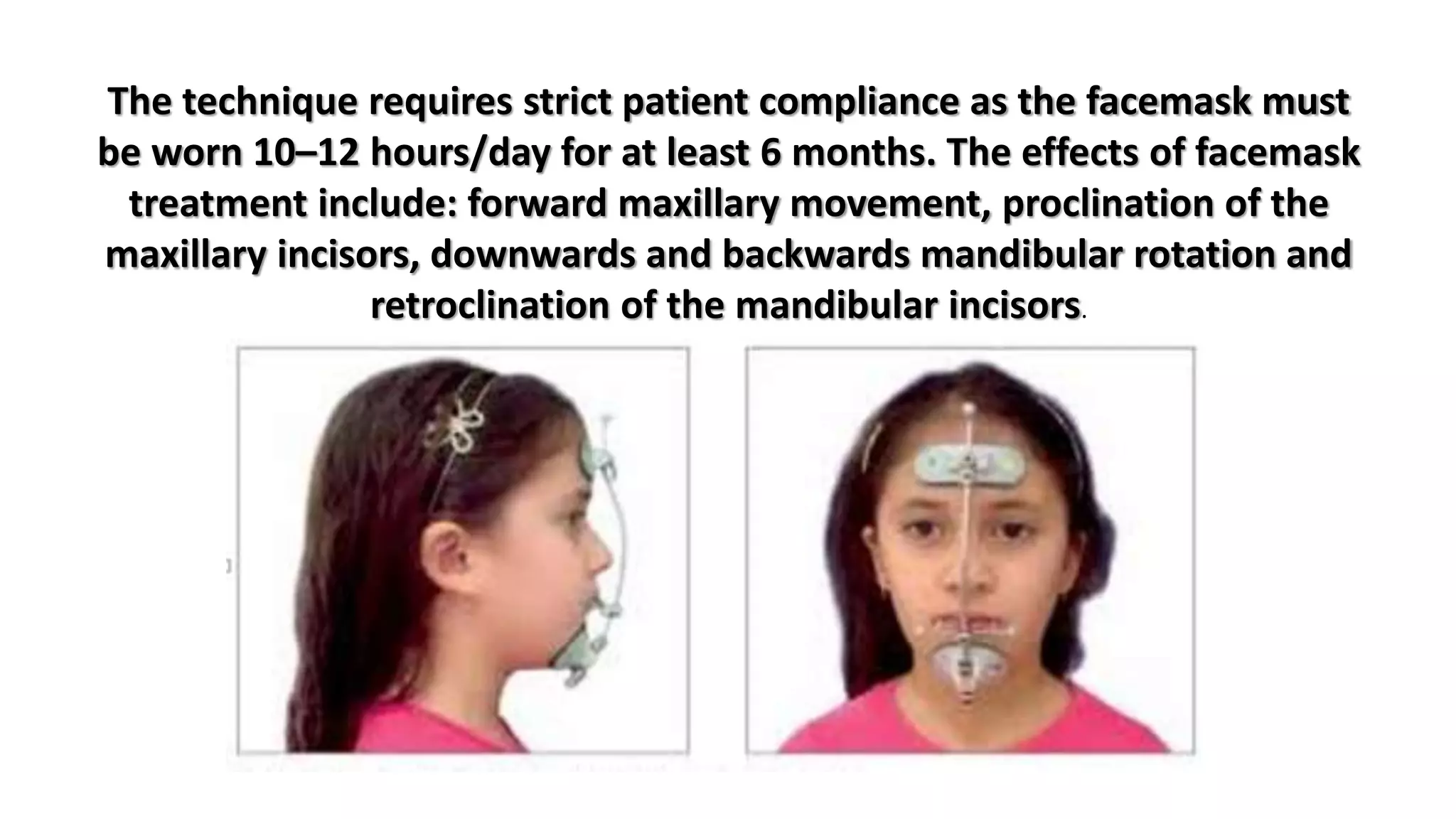 Orthopedic protraction of the maxilla part 1 | PPTX