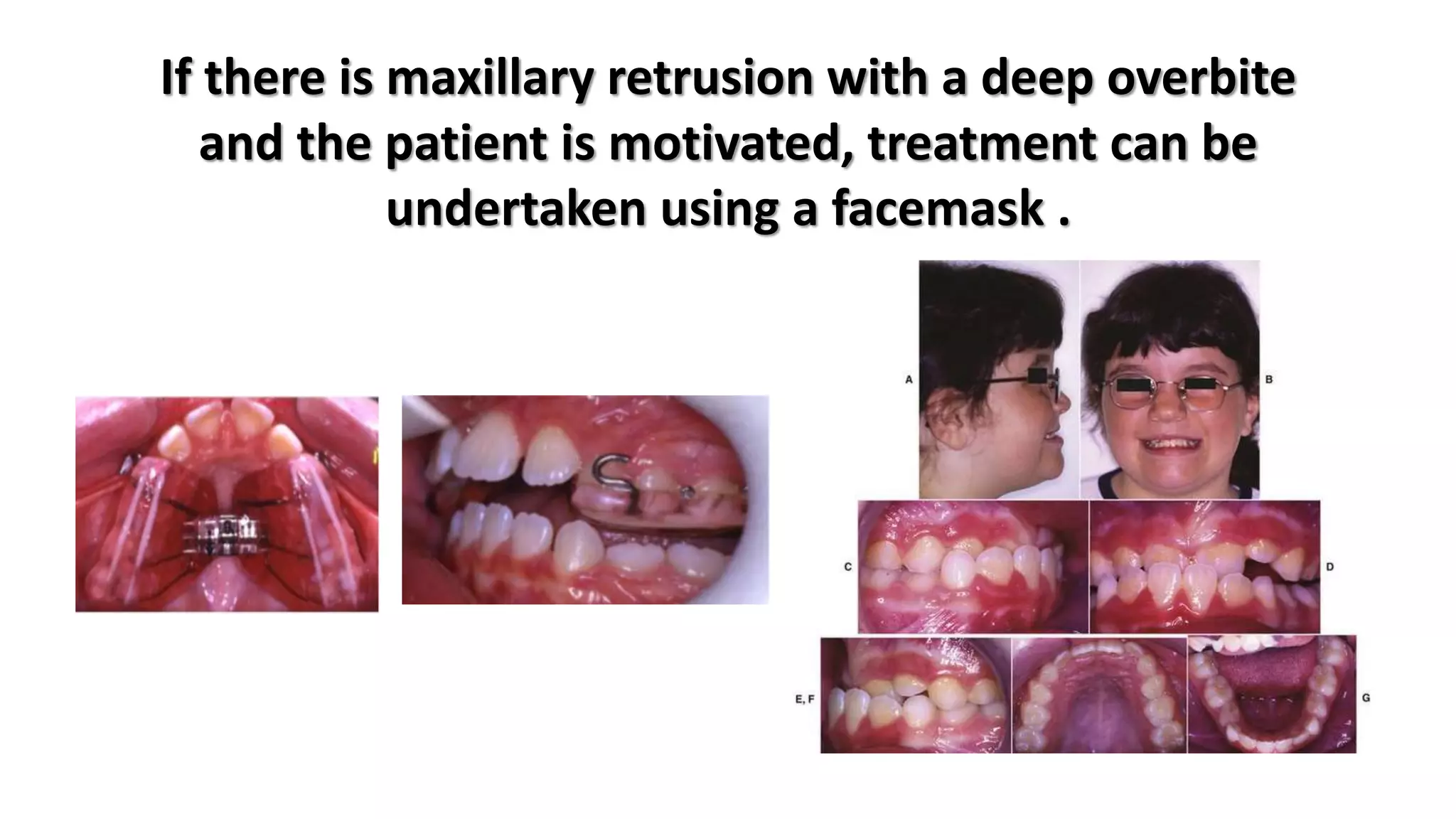 Orthopedic protraction of the maxilla part 1 | PPTX | Oral care | Personal Care