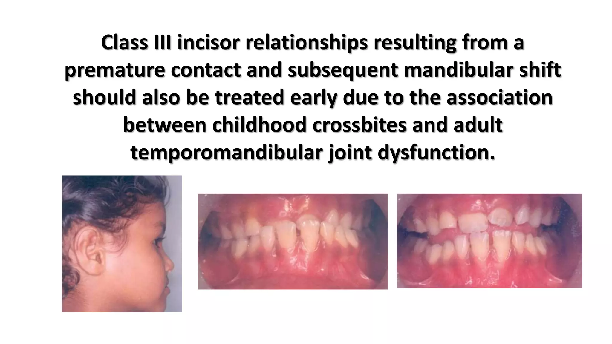 Orthopedic protraction of the maxilla part 1 | PPTX