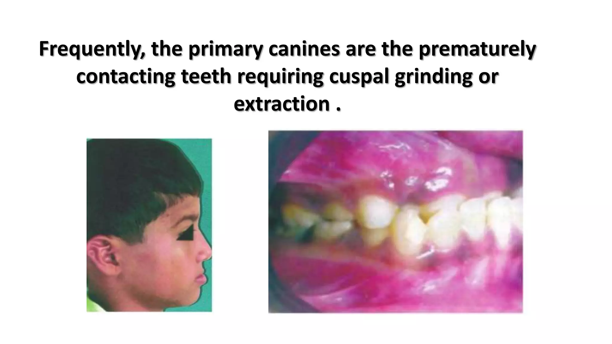 Orthopedic protraction of the maxilla part 1 | PPTX | Oral care | Personal Care