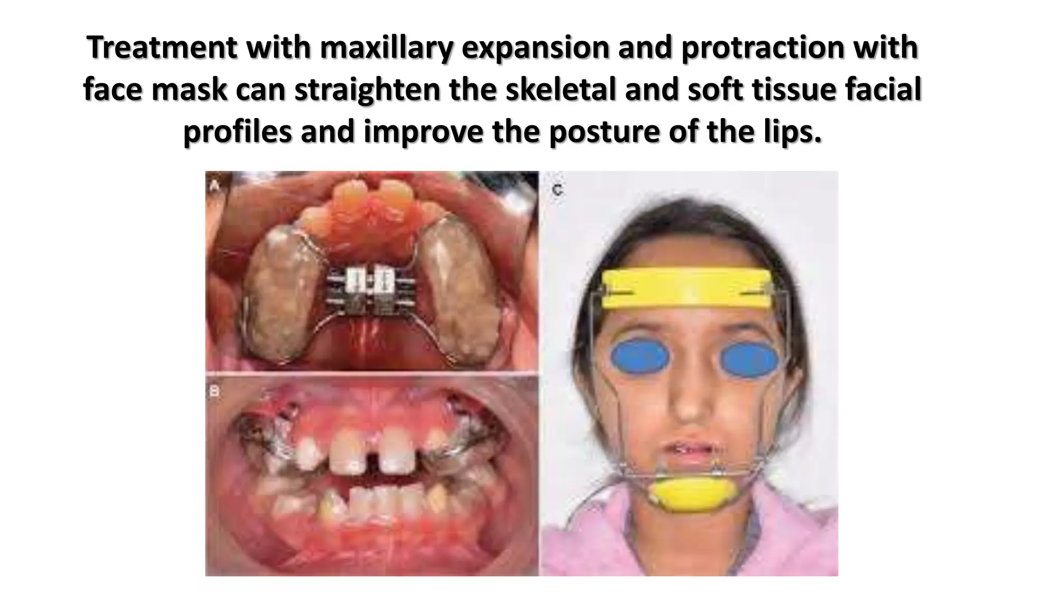 Orthopedic protraction of the maxilla part 1 | PPTX